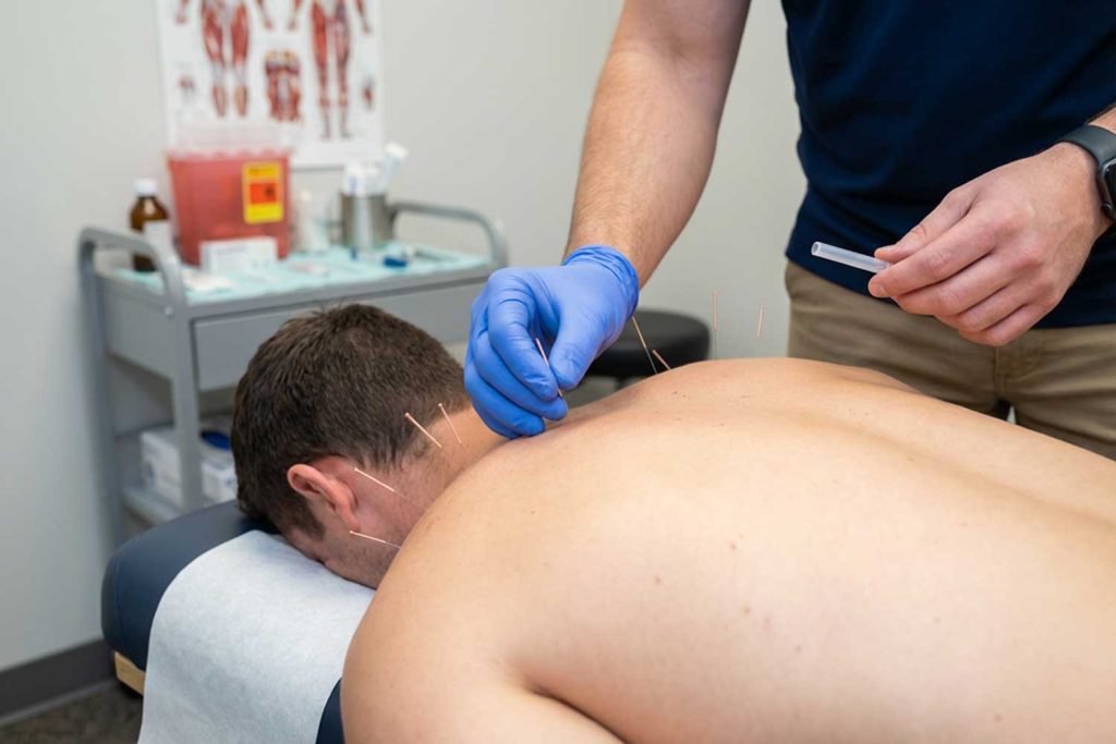 Dry Needling Therapy - CTC Integrated Healthcare